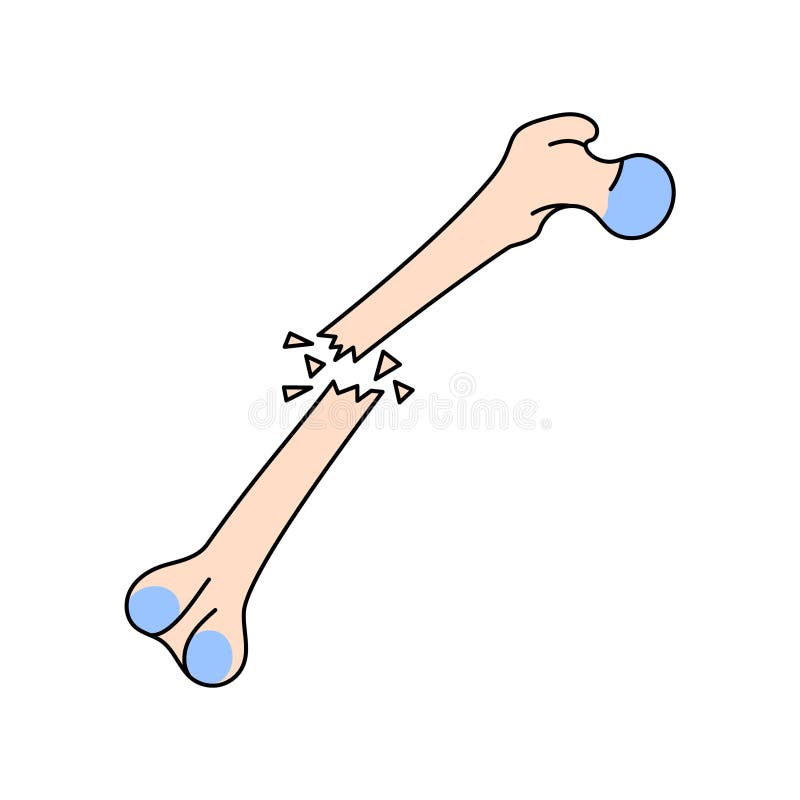 Open Bone Fracture Line Icon. Stock Vector - Illustration of cartilage ...