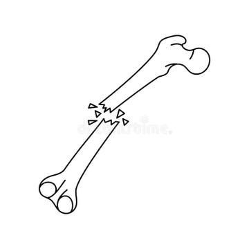 Open Fracture Bone Stock Illustrations – 236 Open Fracture Bone Stock ...