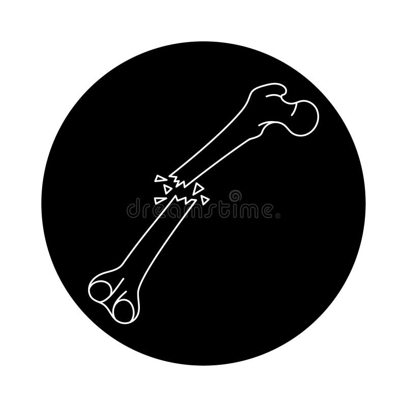 Open Fracture Stock Illustrations – 644 Open Fracture Stock ...