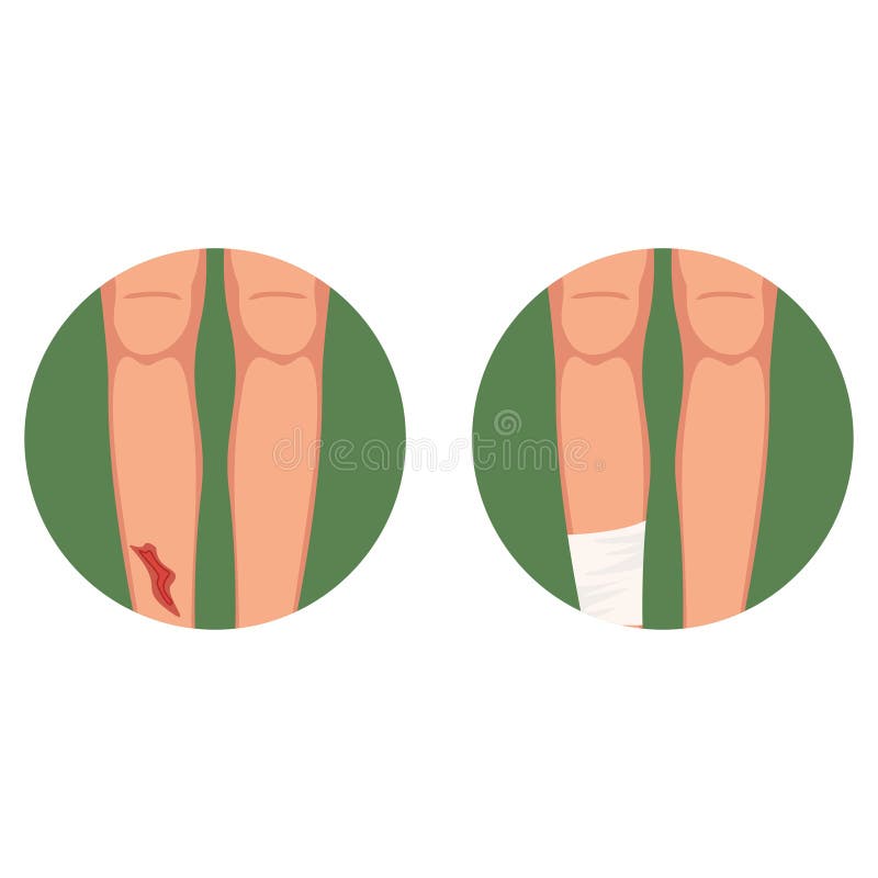 Open Fracture Of The Leg With Dislocation Stock Illustration ...