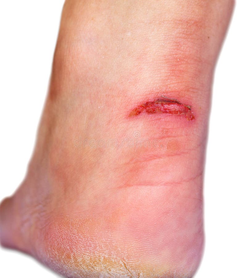 Open wound in heel stock image. Image of shoe, rubbing - 25196847