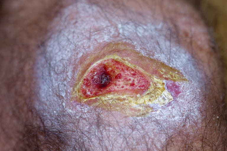 Open wound stock photo. Image of knee, granulation, scab - 36494894