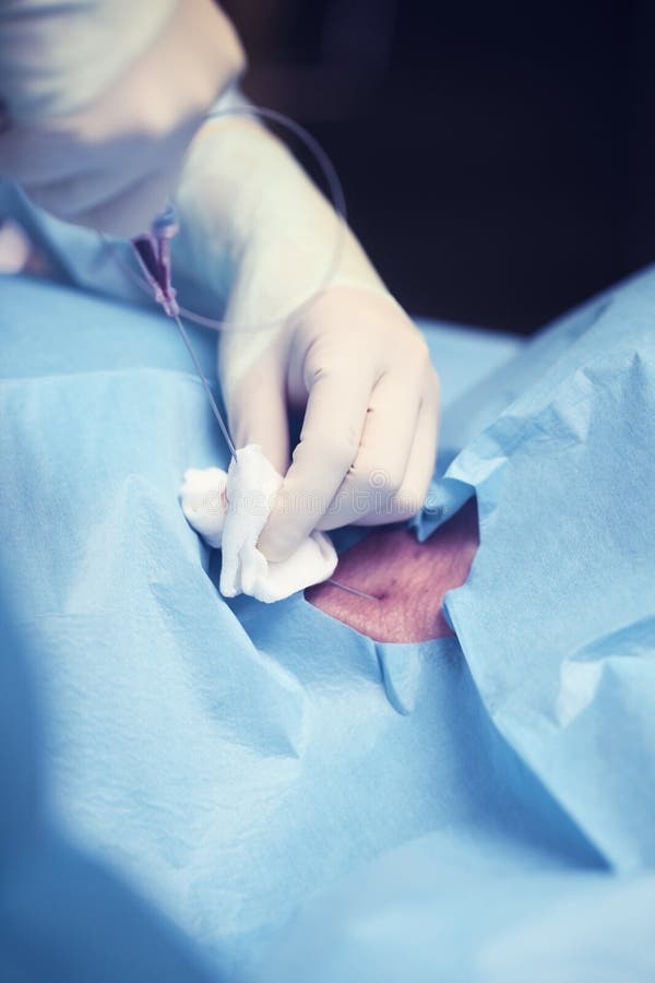 Injection into the Catheter from the Patient. Stock Photo - Image of ...