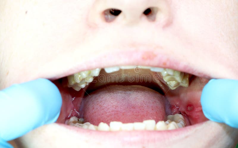 Operation Removal of Wisdom Teeth - Eights. Stitching, Postoperative ...