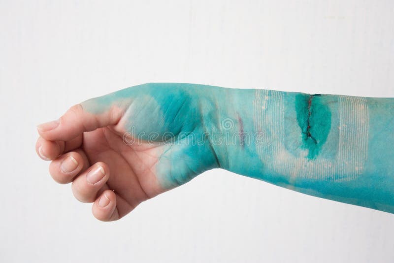 Operation seam on the hand stock image. Image of solution - 141052825