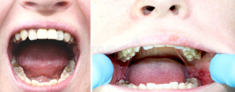 Before and after the Operation To Remove Wisdom Teeth - Eights. Close ...