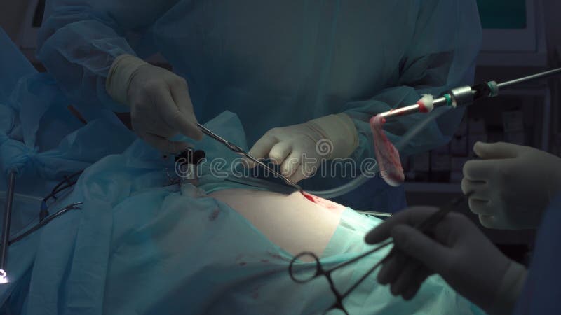 Operation Using Laparoscopic Equipment. Surgeons Team. Hospital. Stock ...