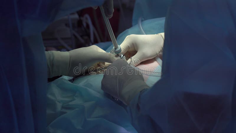 Operation Using Laparoscopic Equipment. Surgeons Team. Hospital. Stock ...