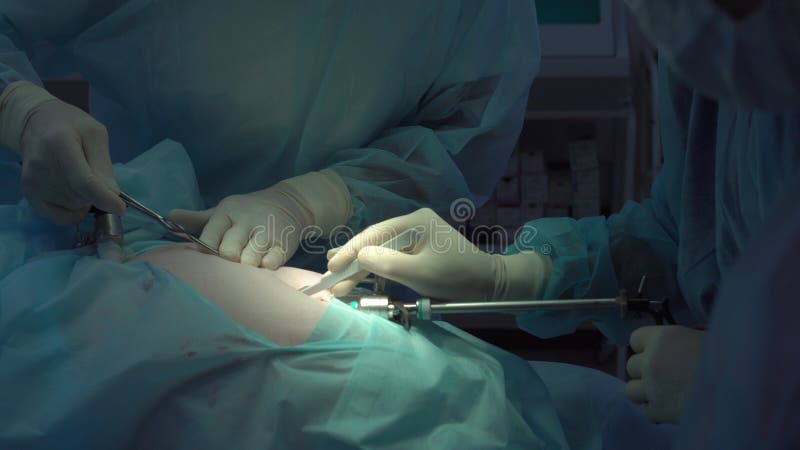 Operation Using Laparoscopic Equipment. Surgeons Team. Hospital. Stock ...