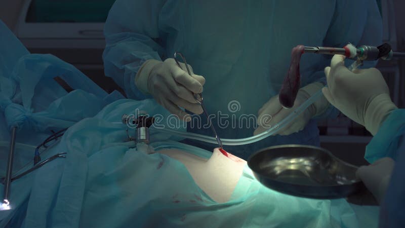Operation Using Laparoscopic Equipment. Surgeons Team. Hospital. Stock ...