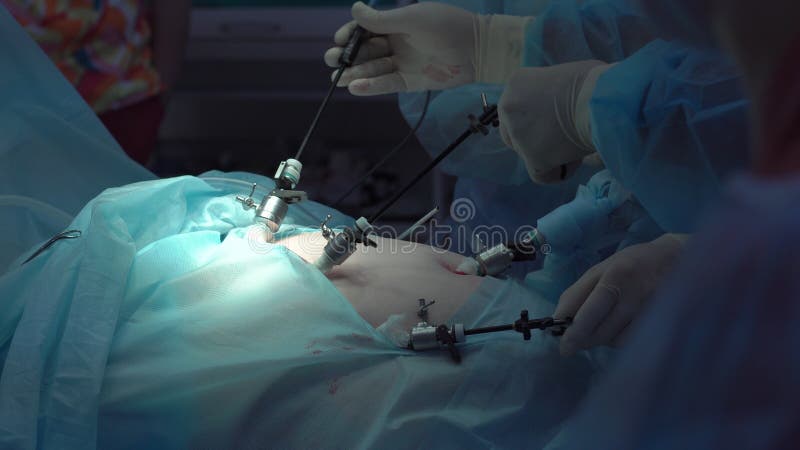Operation Using Laparoscopic Equipment. Surgeons Team Working with of ...