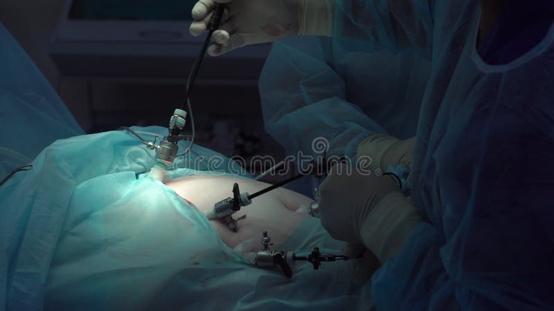 Operation Using Laparoscopic Equipment. Surgeons Team Working with of ...
