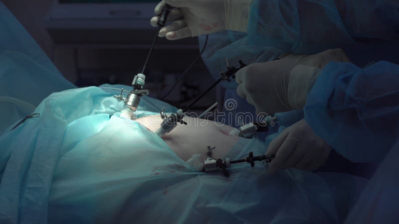 Operation Using Laparoscopic Equipment. Surgeons Team Working with of ...