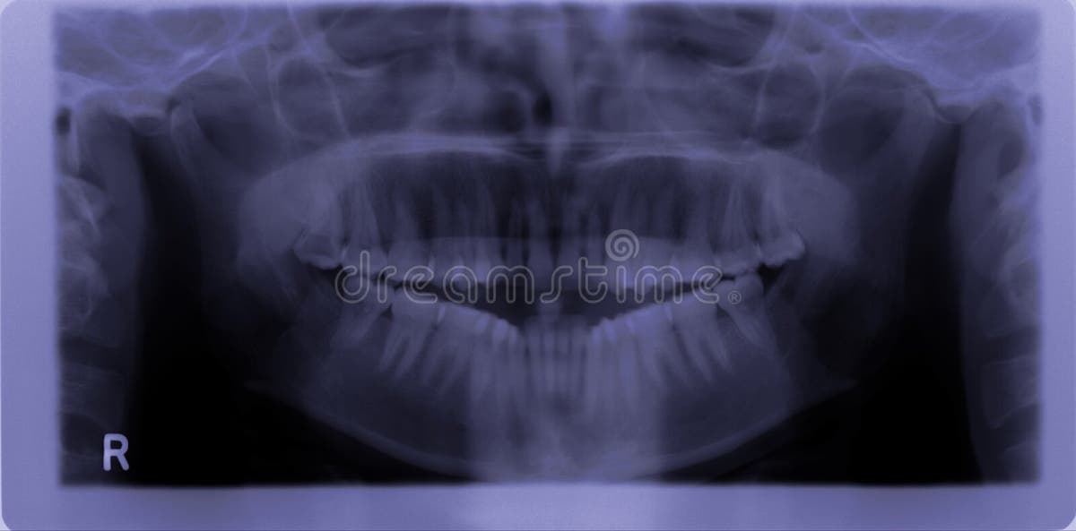 Dental Opg Stock Photos - Free & Royalty-Free Stock Photos from Dreamstime