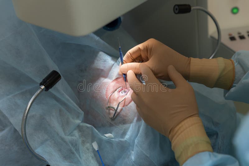 Opthtalmology Laser Operation Editorial Stock Photo - Image of hand ...