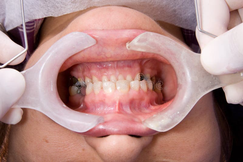 Oral Rehabilitation Process, Partial Removable Prosthesis Stock Photo ...