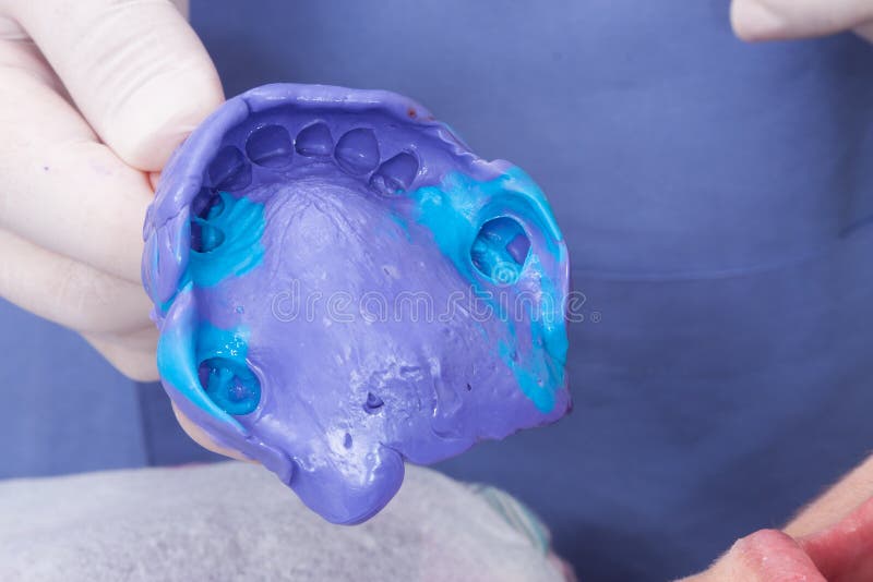 Oral Rehabilitation Process, Partial Removable Prosthesis Stock Image ...