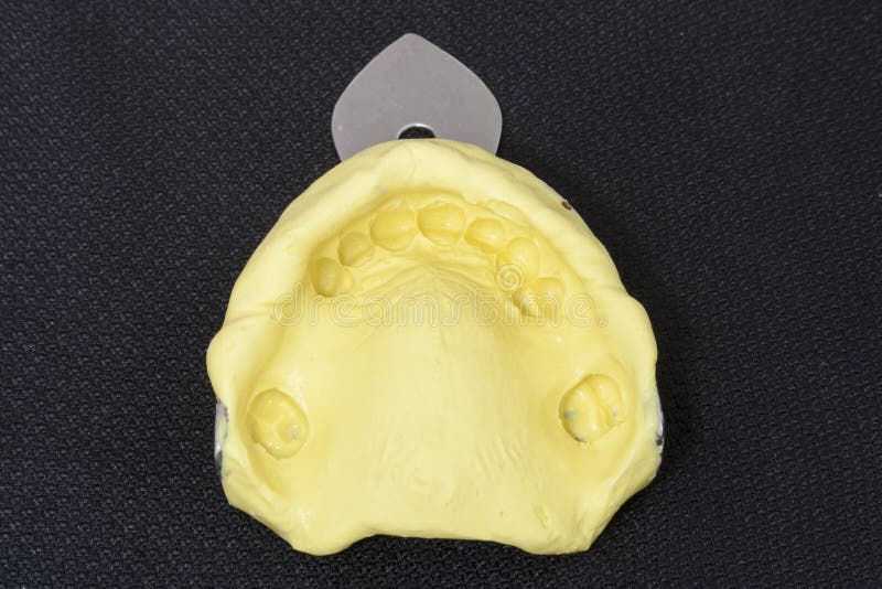 Oral Rehabilitation Process, Partial Removable Prosthesis Stock Image ...