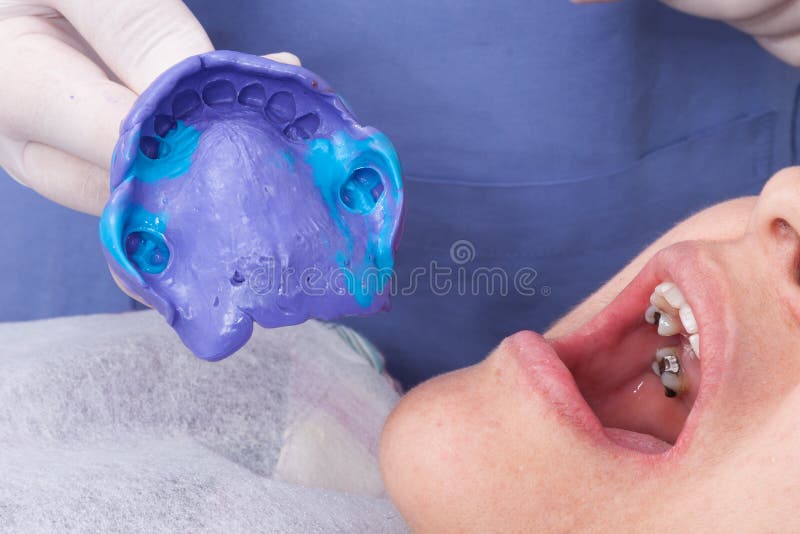 Oral Rehabilitation Process, Partial Removable Prosthesis Stock Image ...