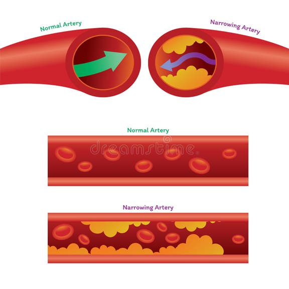 Normal Artery and Narrow Artery because Cholesterol Fat Cell Stock ...