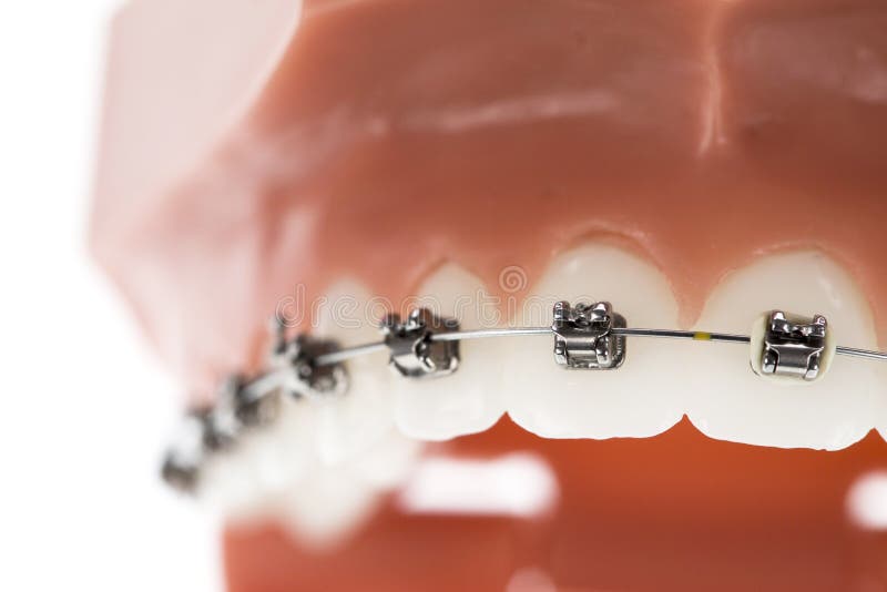 Orthodontic Braces and Brackets Stock Photo - Image of objects ...