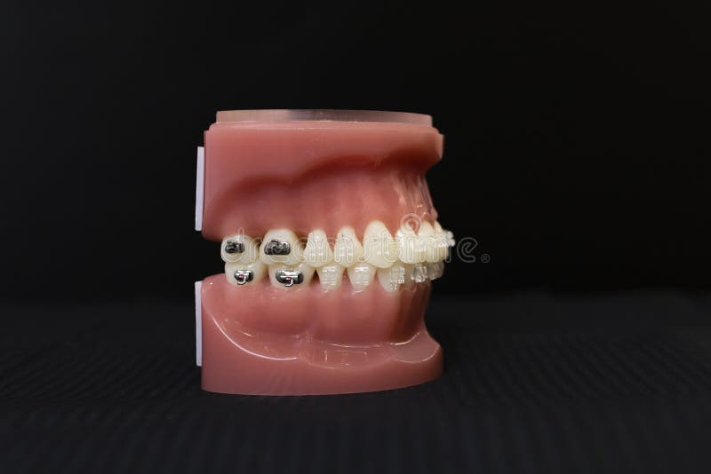 Orthodontic Jaw Model, Demonstration Teeth with Ceramic Bracket or ...