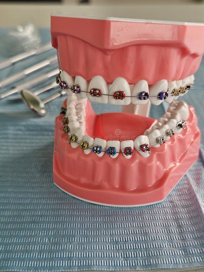Orthodontic Model Showcasing Colorful Braces in a Dental Office Stock ...
