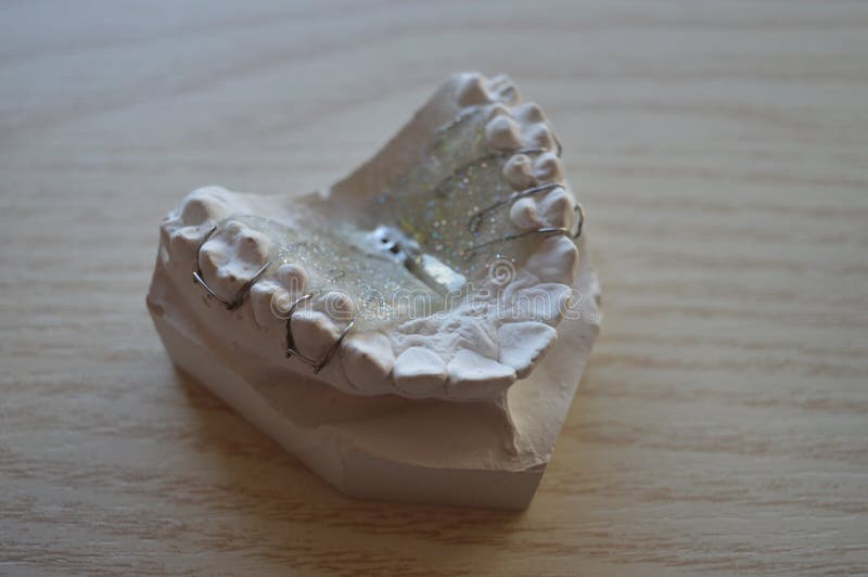 Orthodontic Teeth Alignment Plate Stock Photo - Image of instrument ...