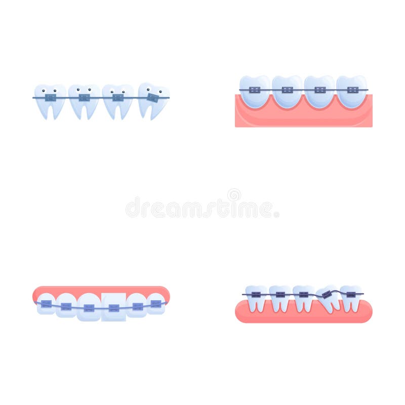 Orthodontic Treatment Icons Set Cartoon Vector. Various Brace System on Teeth Stock Vector ...