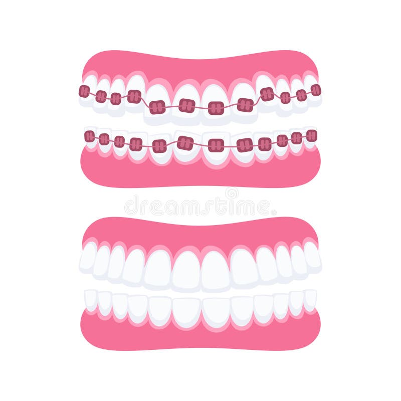 Orthodontic Treatment Showing Teeth with and without Braces Stock ...