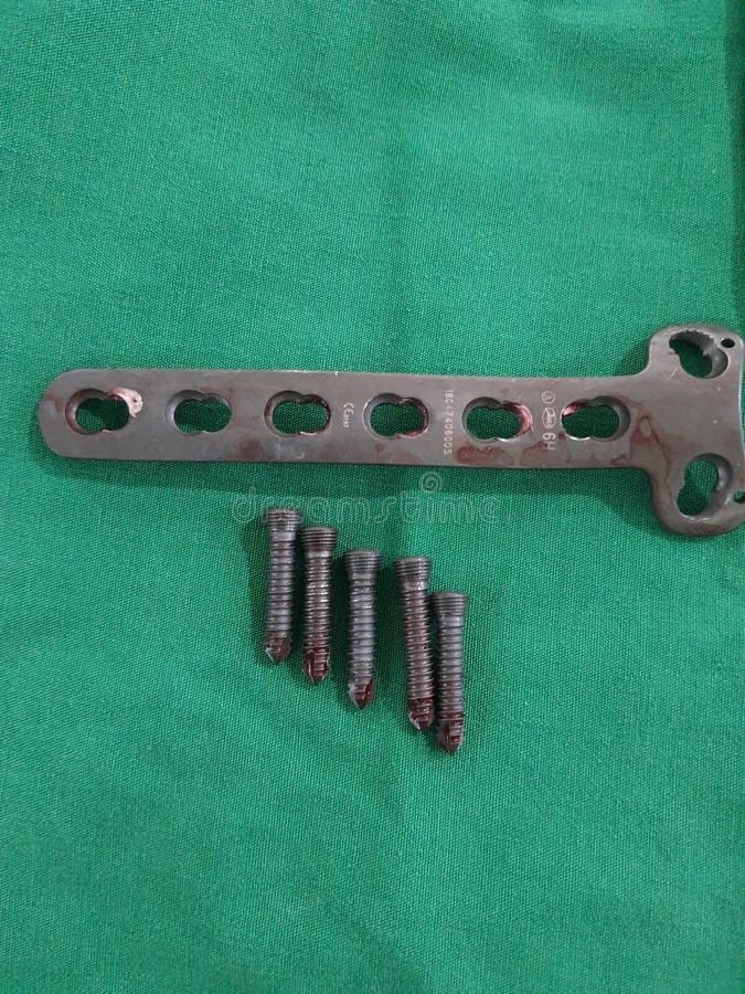 141 Orthopaedic Plate Stock Photos - Free & Royalty-Free Stock Photos ...