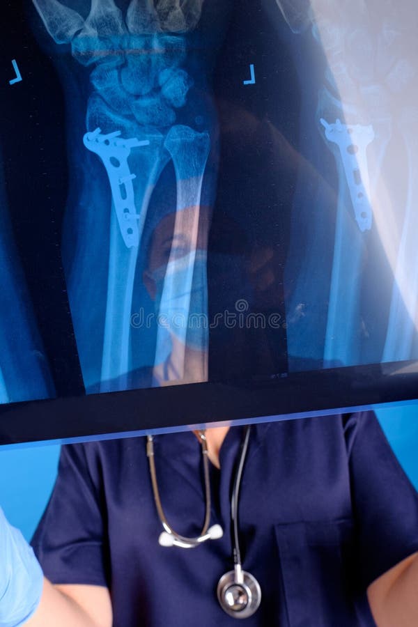Orthopaedic Surgeon Looking at X-Rays with Steel Plate in Wrist Stock ...