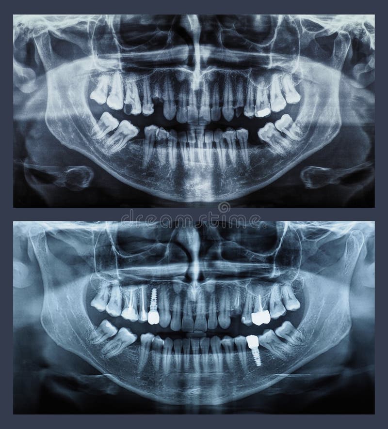 Orthopantomograph Panoramic Image Radiograph of Teeth Stock Photo ...