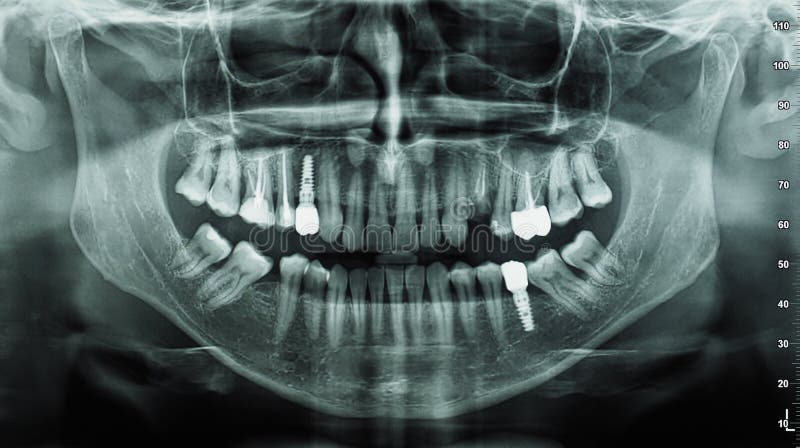 Orthopantomograph Panoramic Image Radiograph of Teeth Stock Photo ...