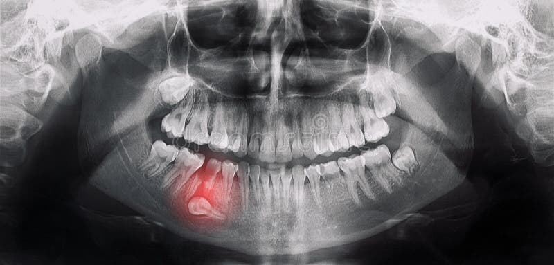 OPG X-ray stock photo. Image of wisdom, film, human - 204309996