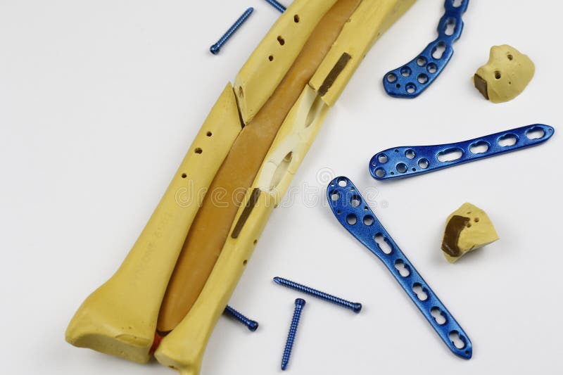 Orthopedic bone implants stock photo. Image of metal - 269742346