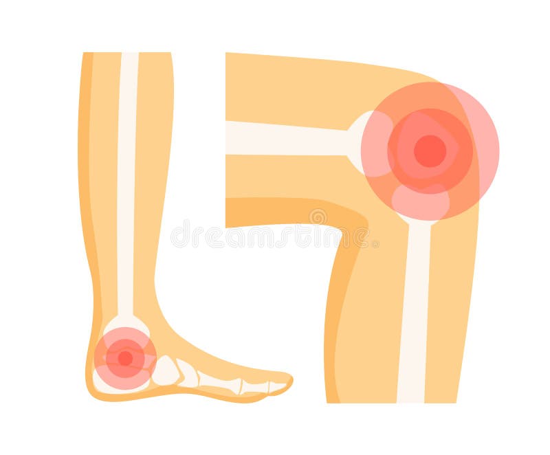 Foot Problems Stock Illustrations – 825 Foot Problems Stock ...