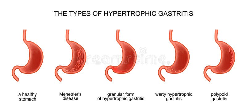 Localização Da Gastrite E Inflamação Do Revestimento Do Estômago. Três ...