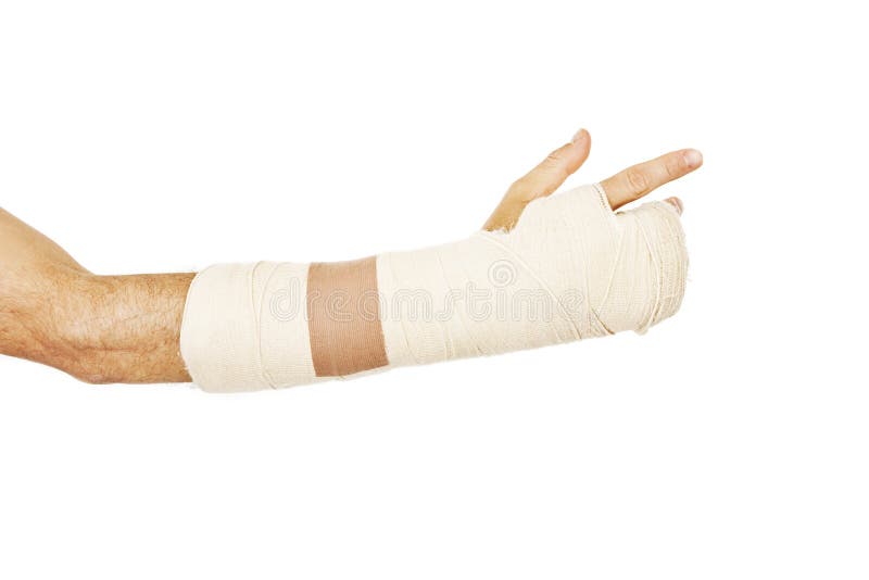 Osso Di Braccio Rotto in Colata Che Fa Segno GIUSTO Fotografia Stock ...