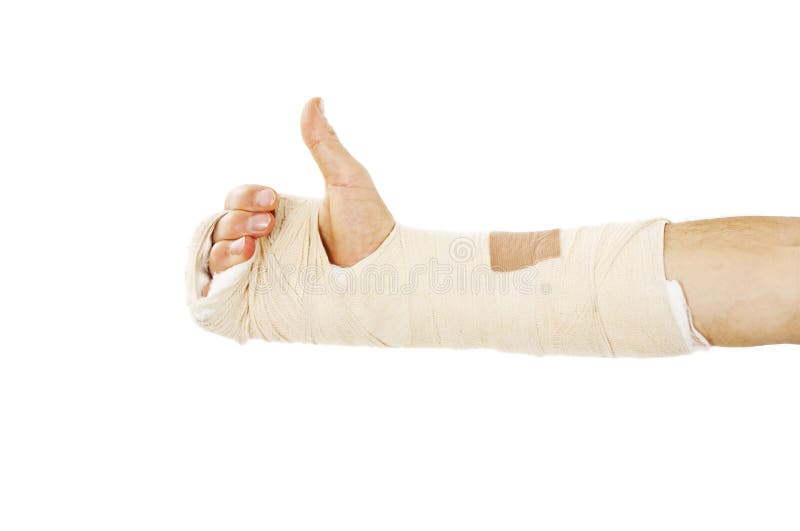 Osso Di Braccio Rotto in Colata Che Fa Segno GIUSTO Fotografia Stock ...