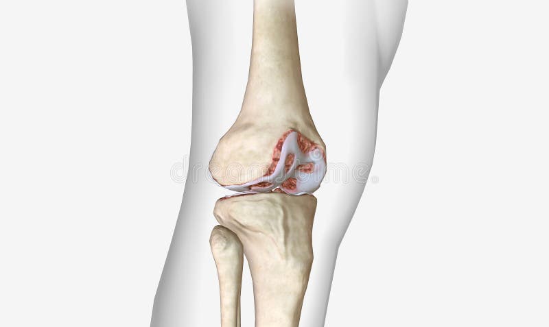 Osteoarthritis is a Degenerative Form of Arthritis that Affects ...