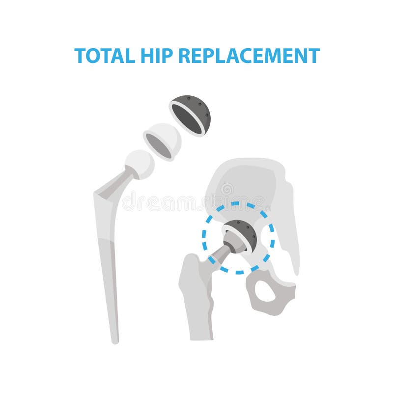 Total Hip Replacement Surgery Stock Illustrations – 59 Total Hip ...