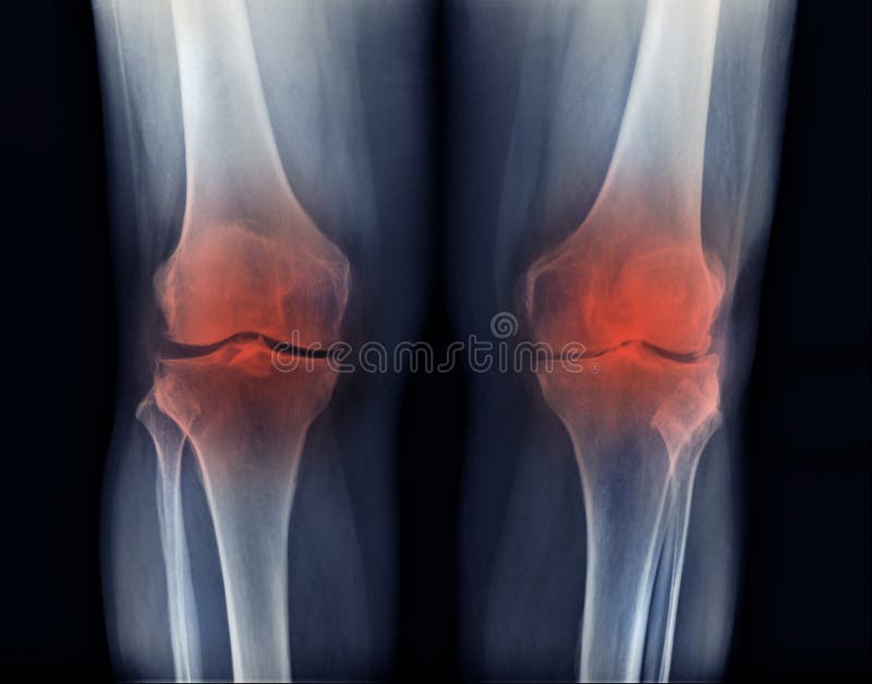 OA knee x-ray image stock photo. Image of medical, joint - 116817596