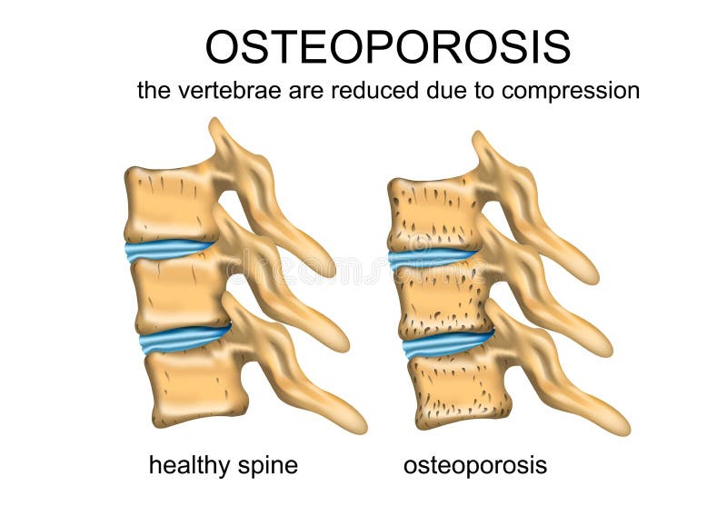 Lumbar Spine Vertebrae Clipart Stock Illustrations – 18 Lumbar Spine ...