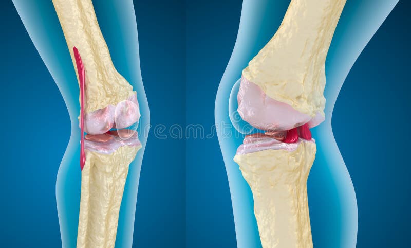 Osteoporosis of the Knee Joint Stock Illustration - Illustration of ...
