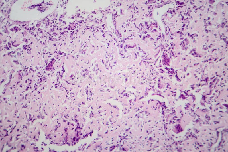 Osteosarcoma Malignant Bone Tumor Light Micrograph Under Microscope ...