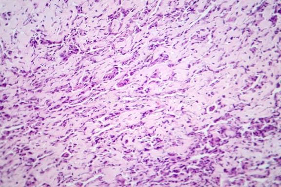 Osteosarcoma, a Malignant Bone Tumor, Light Micrograph Under the ...