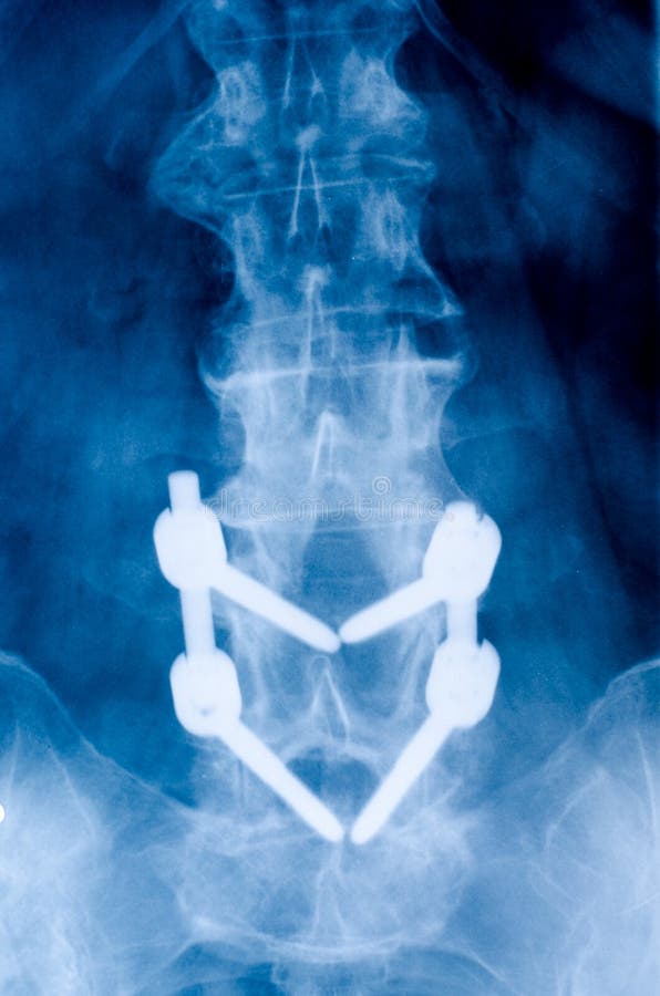 Osteosynthesis Fotos - Fotos de Stock Gratuitas e Fotos Royalty-Free ...