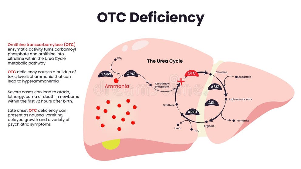 Ornithine Transcarbamylase (OTC) Deficiency Diagram Vector Stock Vector ...