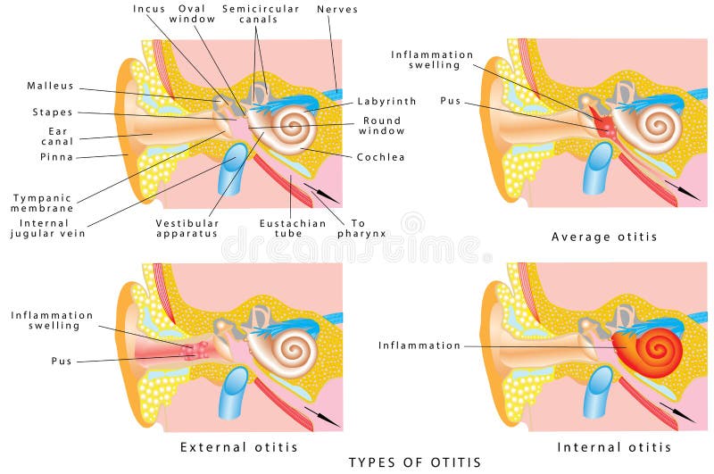 La Maladie De Mal D'oreille Et Inflammation De La Douleur Aux Oreilles ...